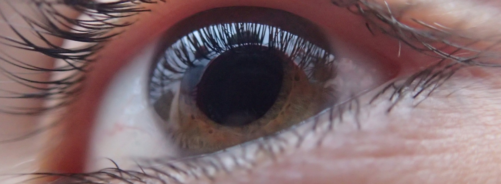 Chronic Dry Eye Treatment Options and Tips for an Eye-Healthy Lifestyle